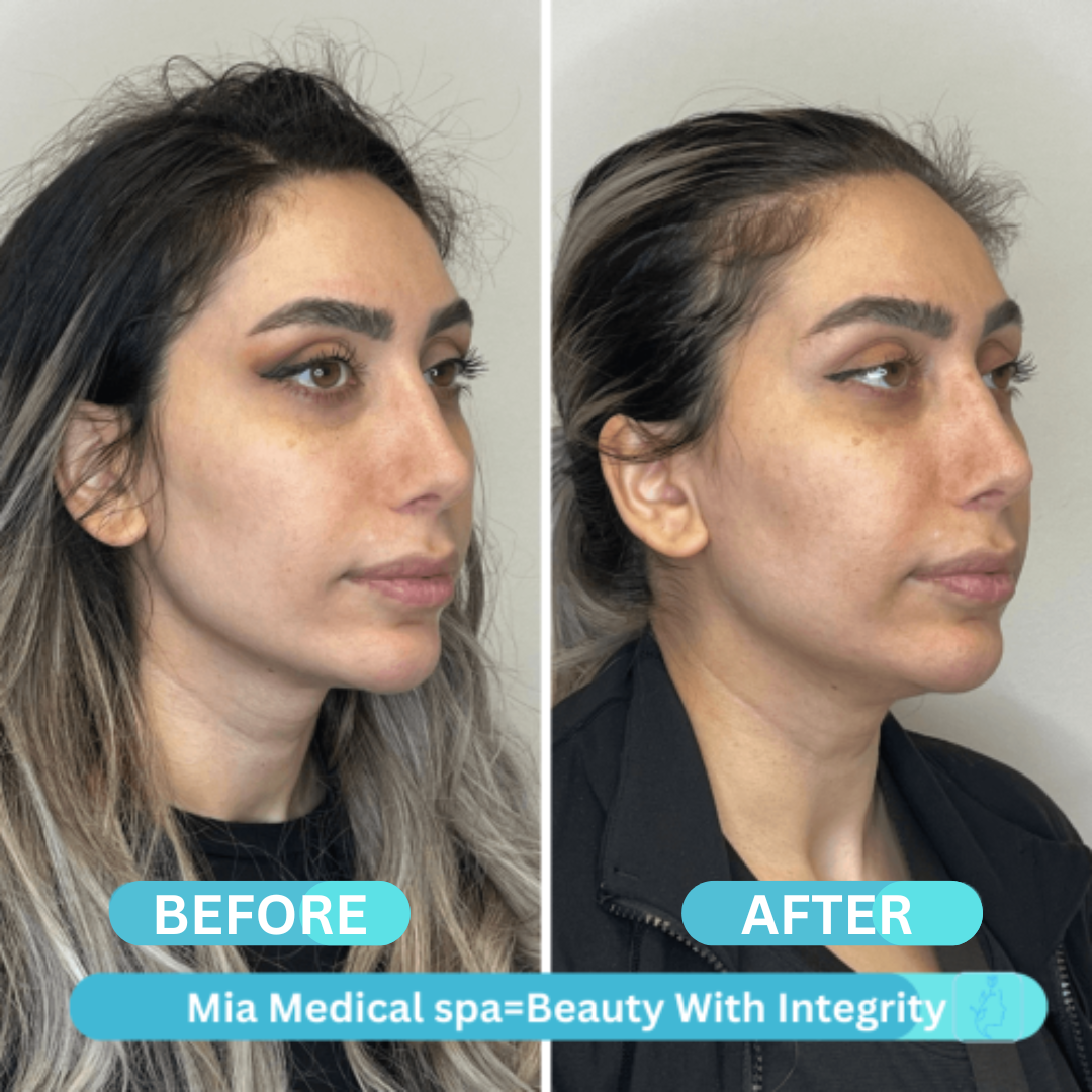 Before & After in Beaverton, OR | Mia Medical Spa