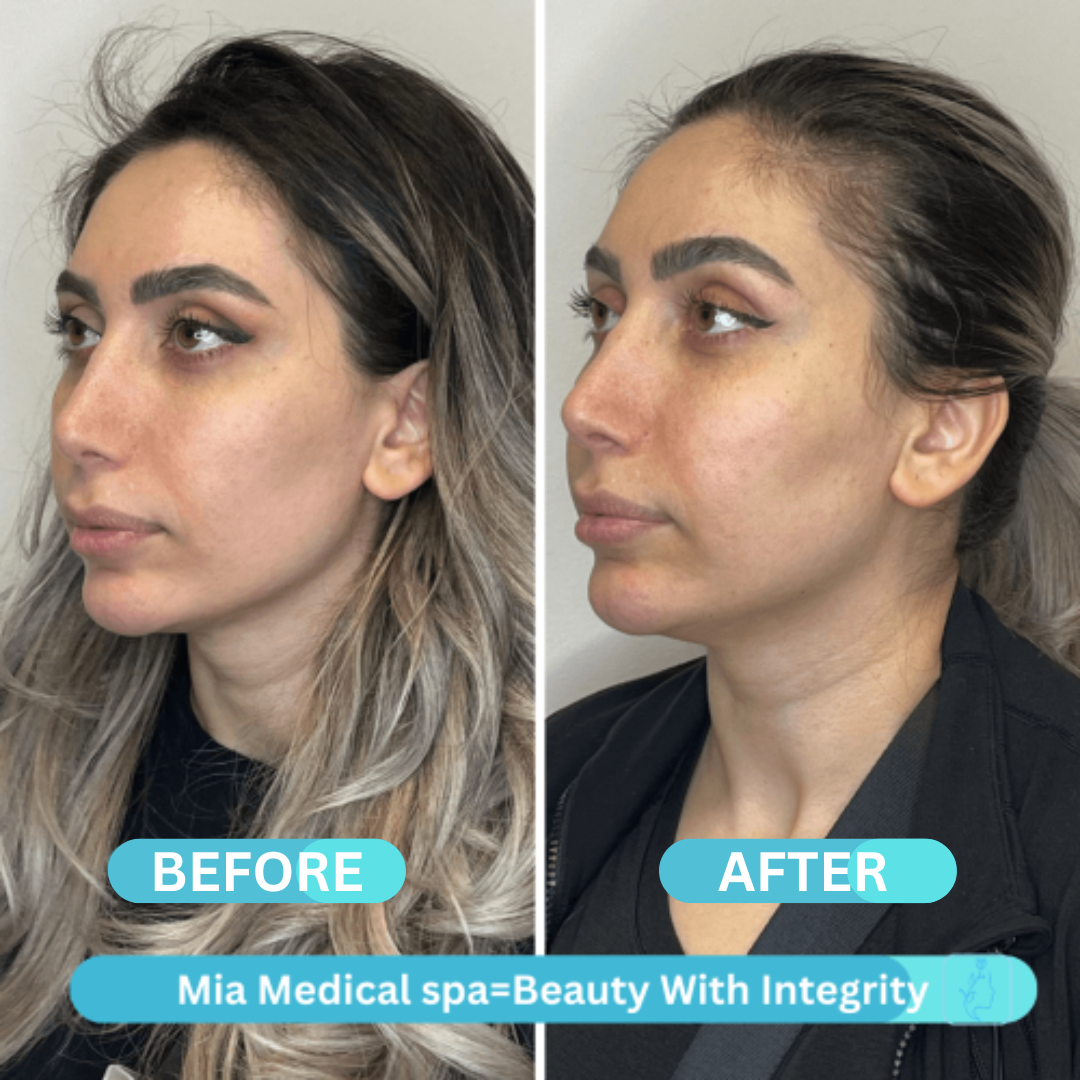 Before & After in Beaverton, OR | Mia Medical Spa